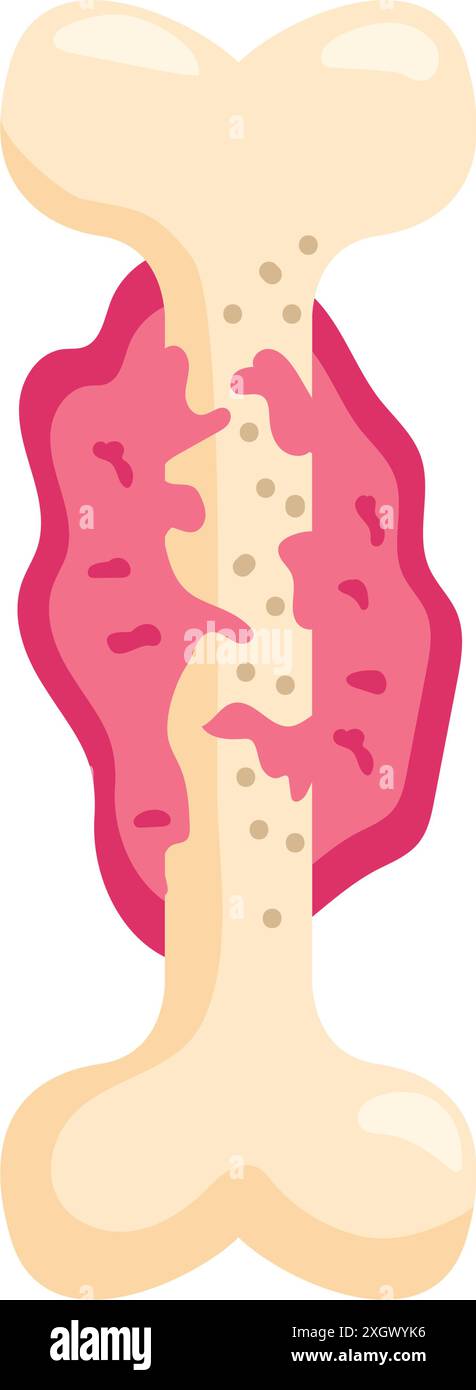 Sarcoma cancer awareness campaign Stock Vector Images - Alamy