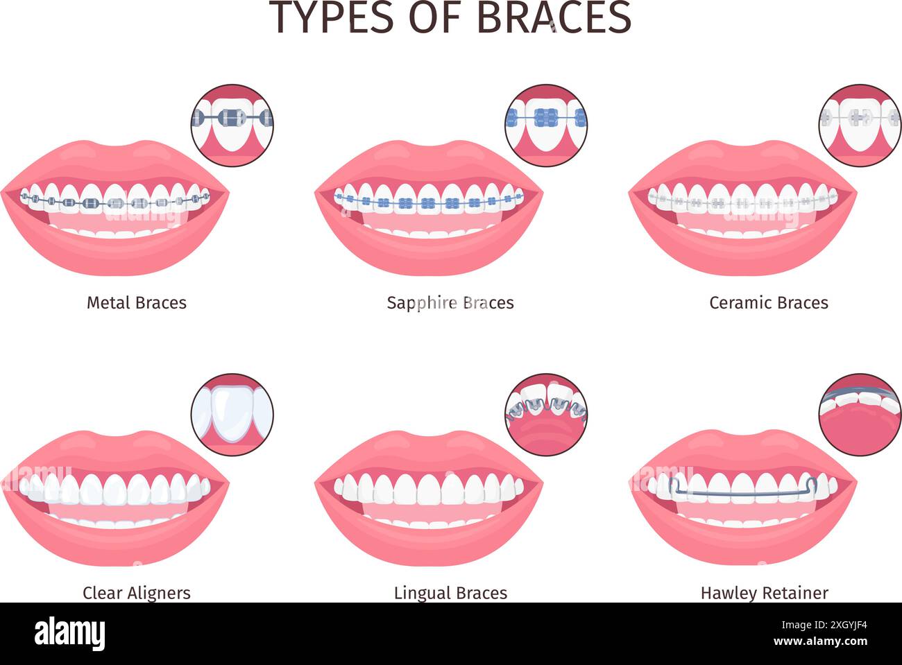 Braces types. Dental bracket teeth retainer type, metalic plastic ...