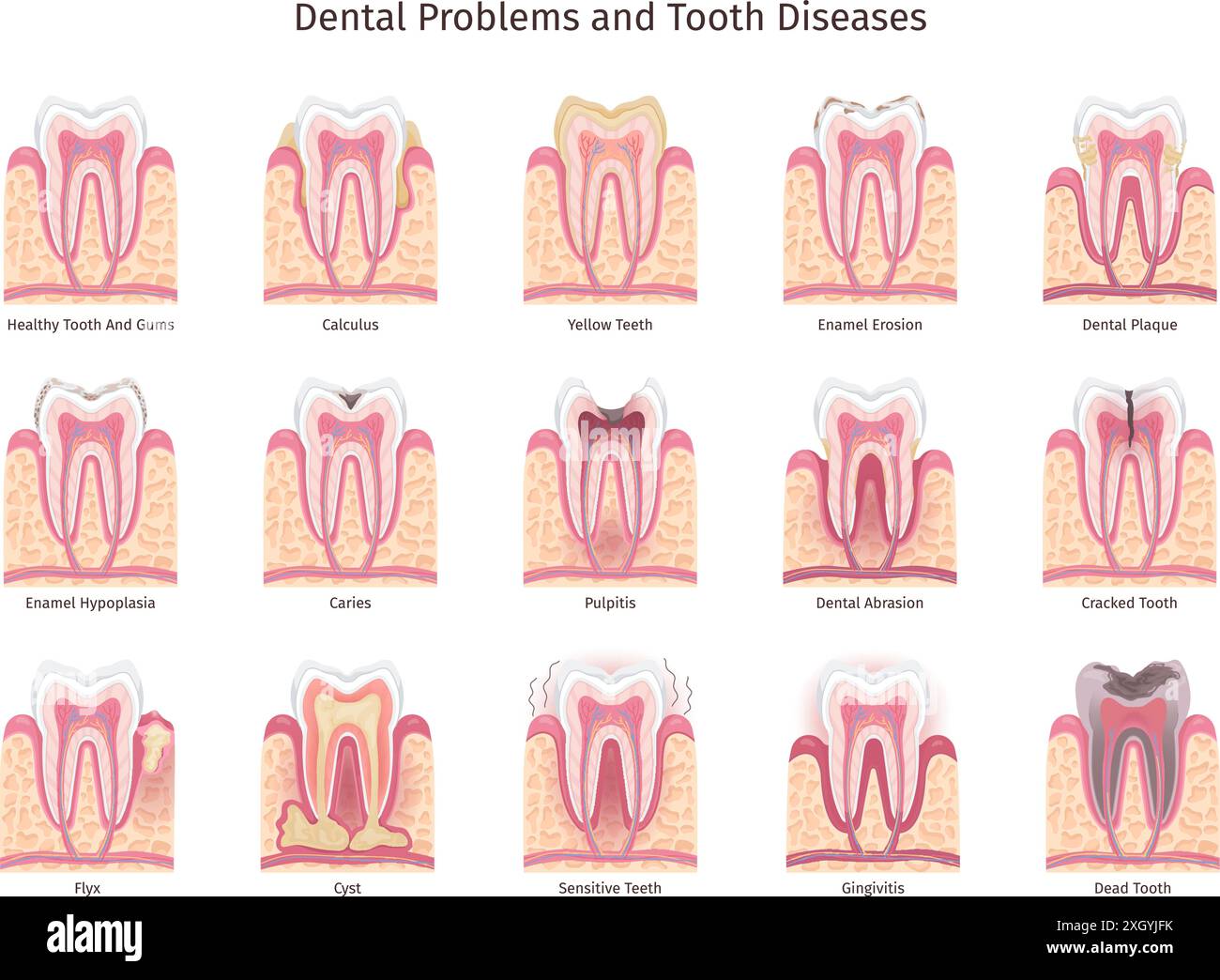 Teeth problems infographic. Human tooth decay, oral cavity problem ...