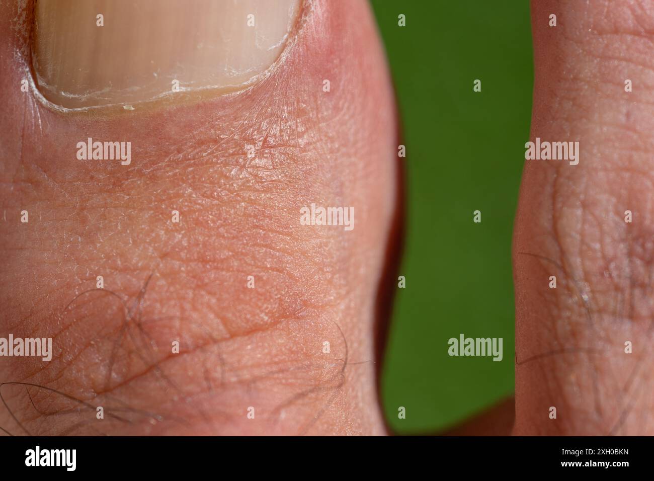 Black toe hairs coming out of the skin in detail Stock Photo - Alamy