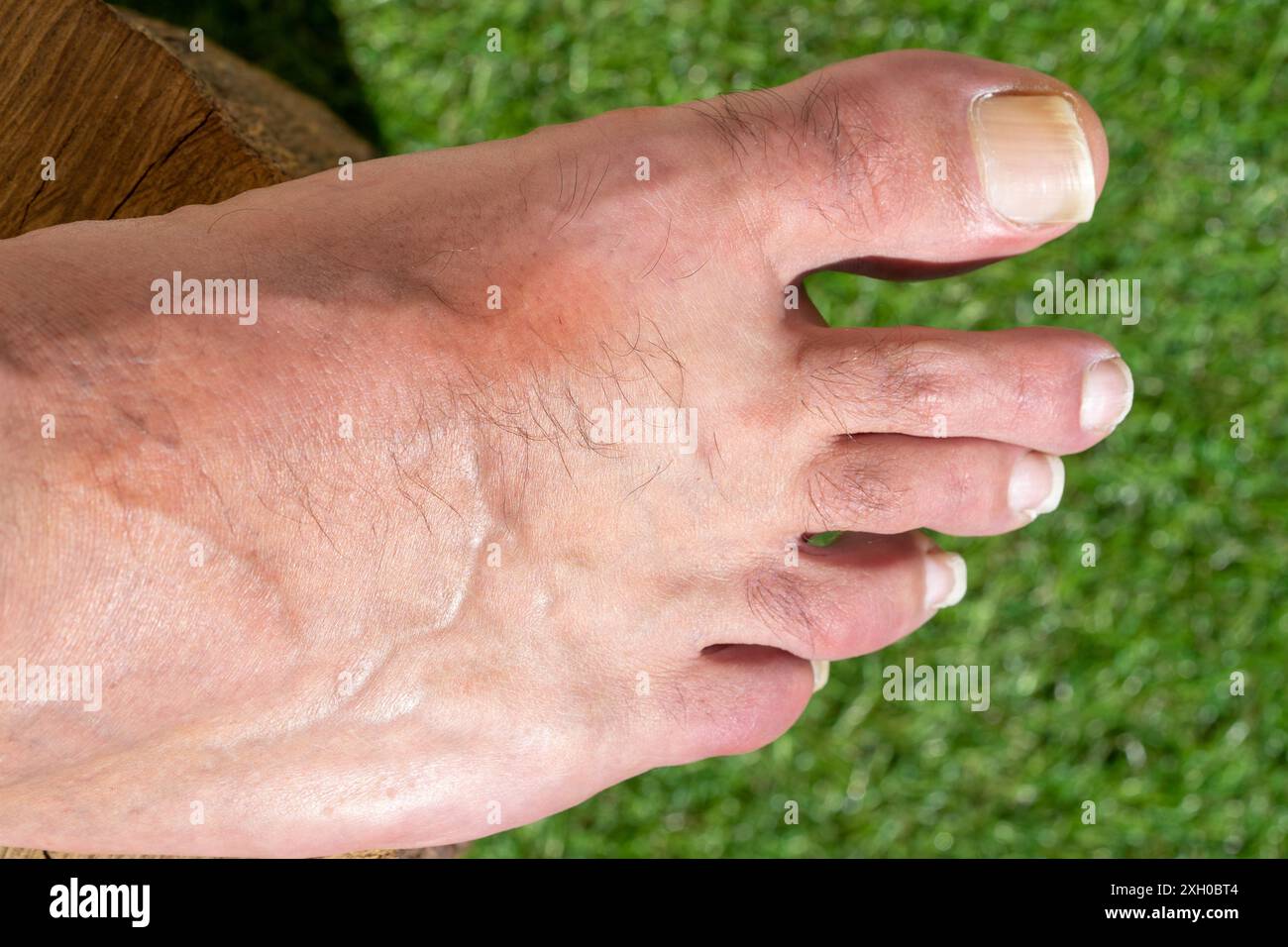Set of the 5 toes of the right foot of a human being on a green ...