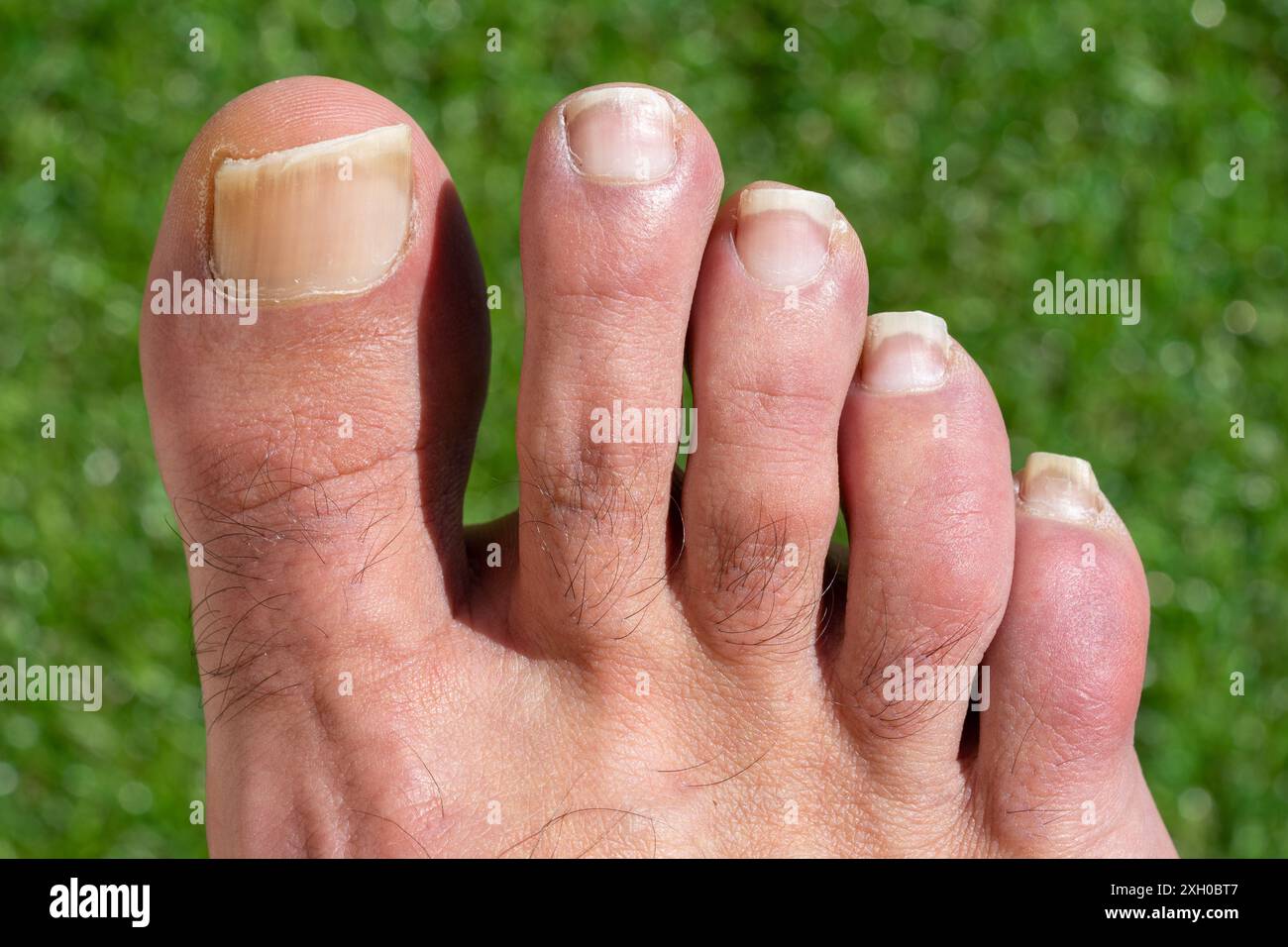 Set of the 5 toes of the right foot of a human being on a green ...