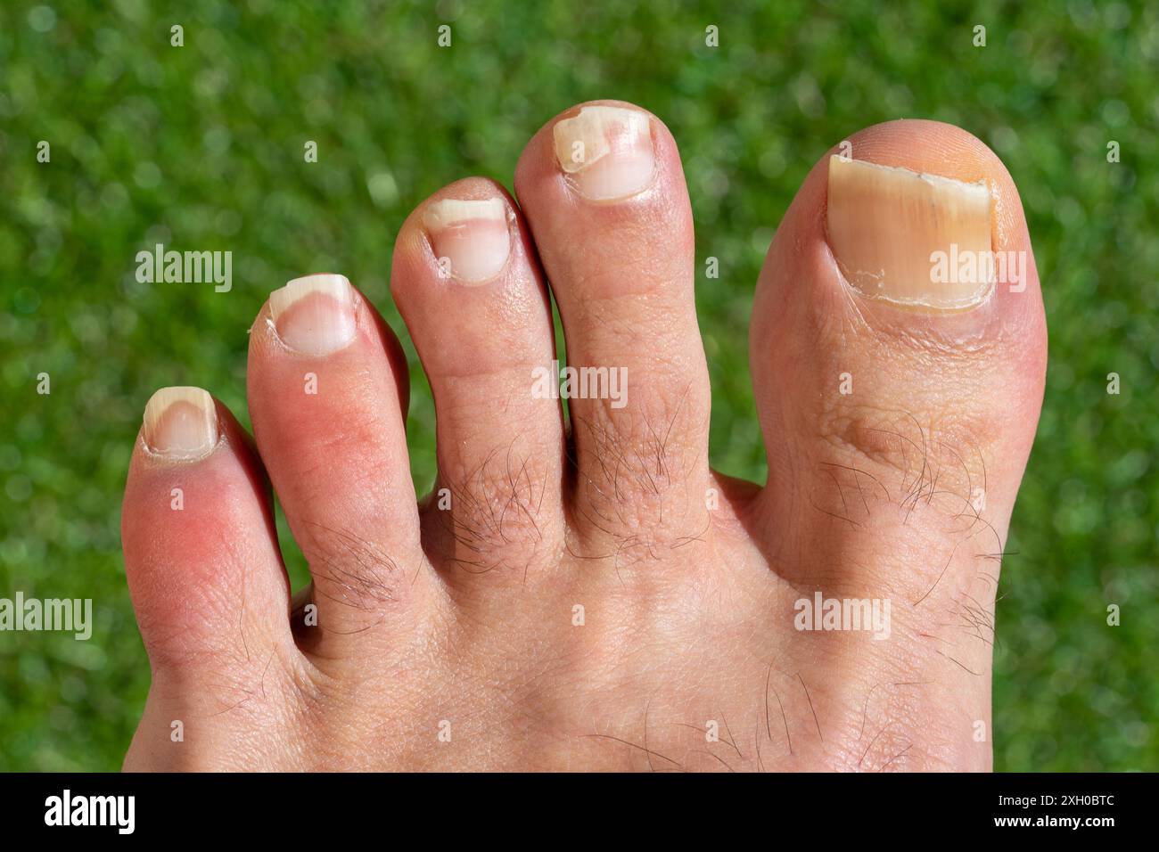 Set of toes where one of the nails is broken Stock Photo - Alamy