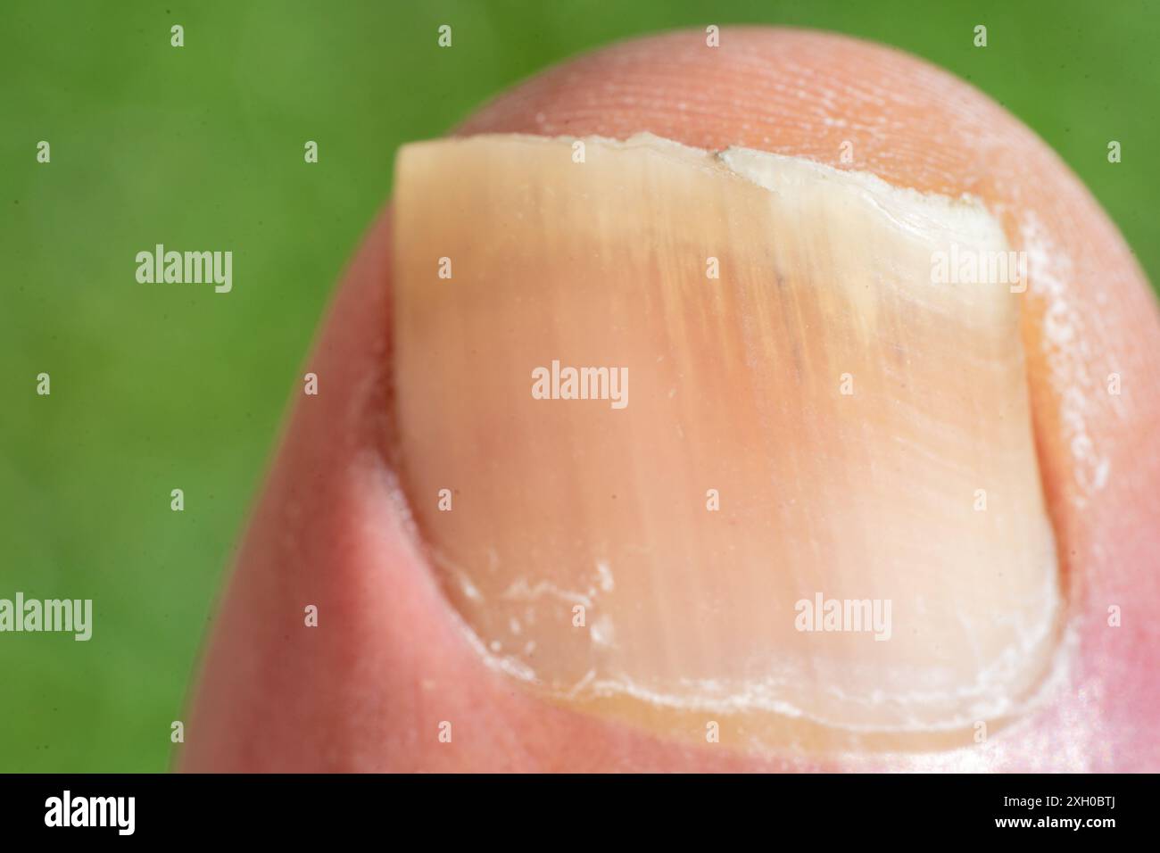 Right big toe with poorly cut nail on green background Stock Photo - Alamy