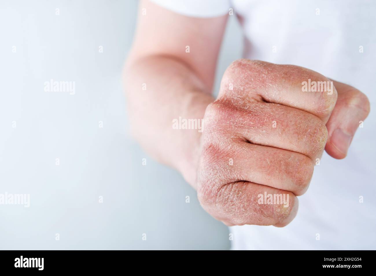 Man scratches or shows hands with dry, cracked skin on white ...