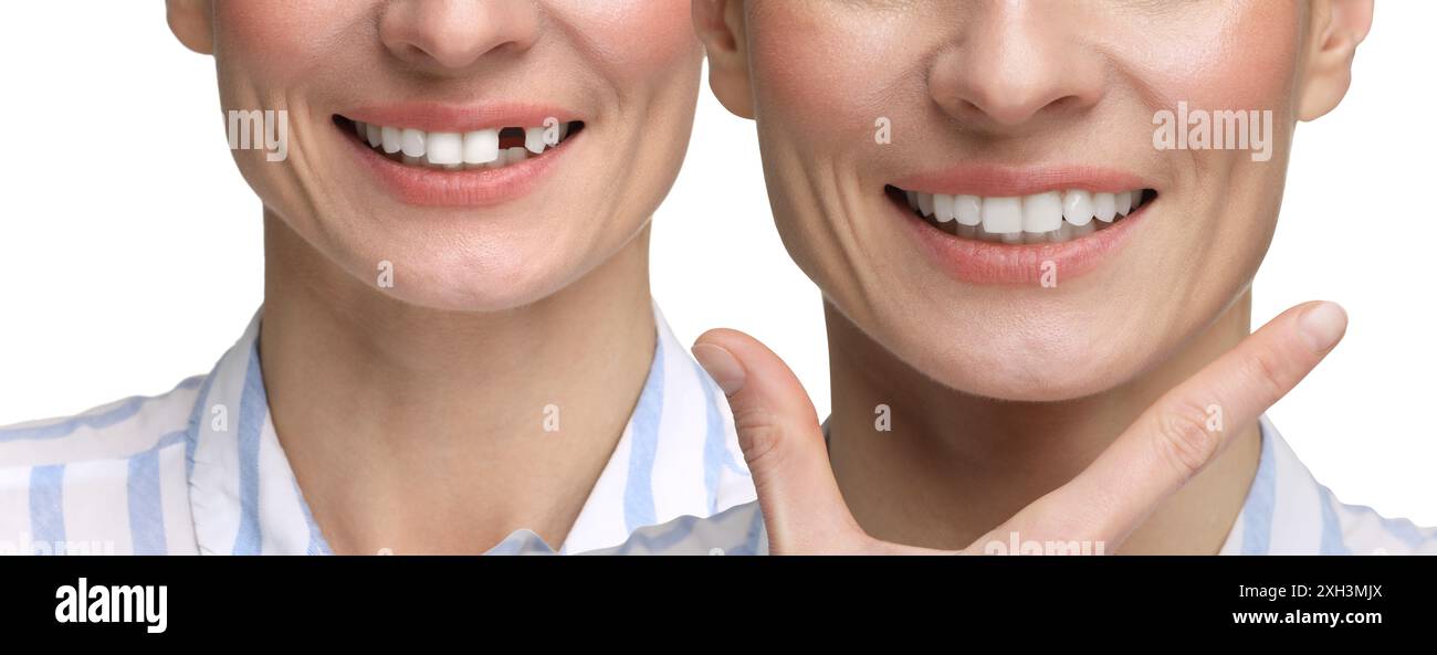 Woman showing teeth before and after dental implant surgery, closeup ...