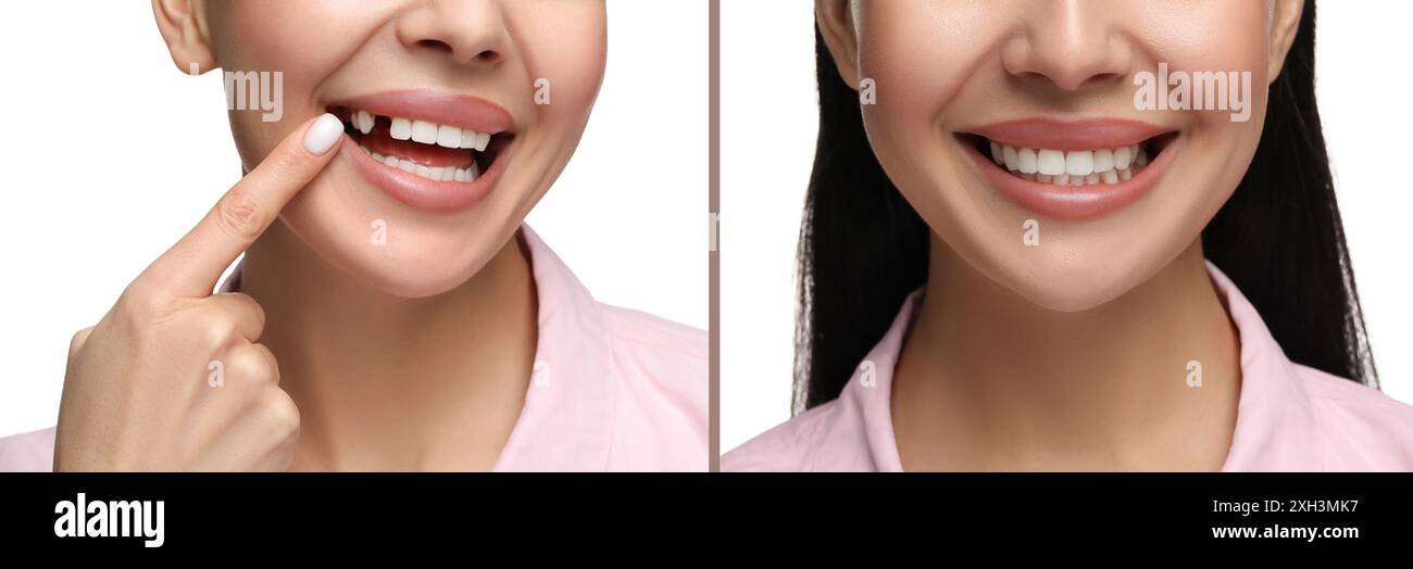 Woman showing teeth before and after dental implant surgery, closeup ...