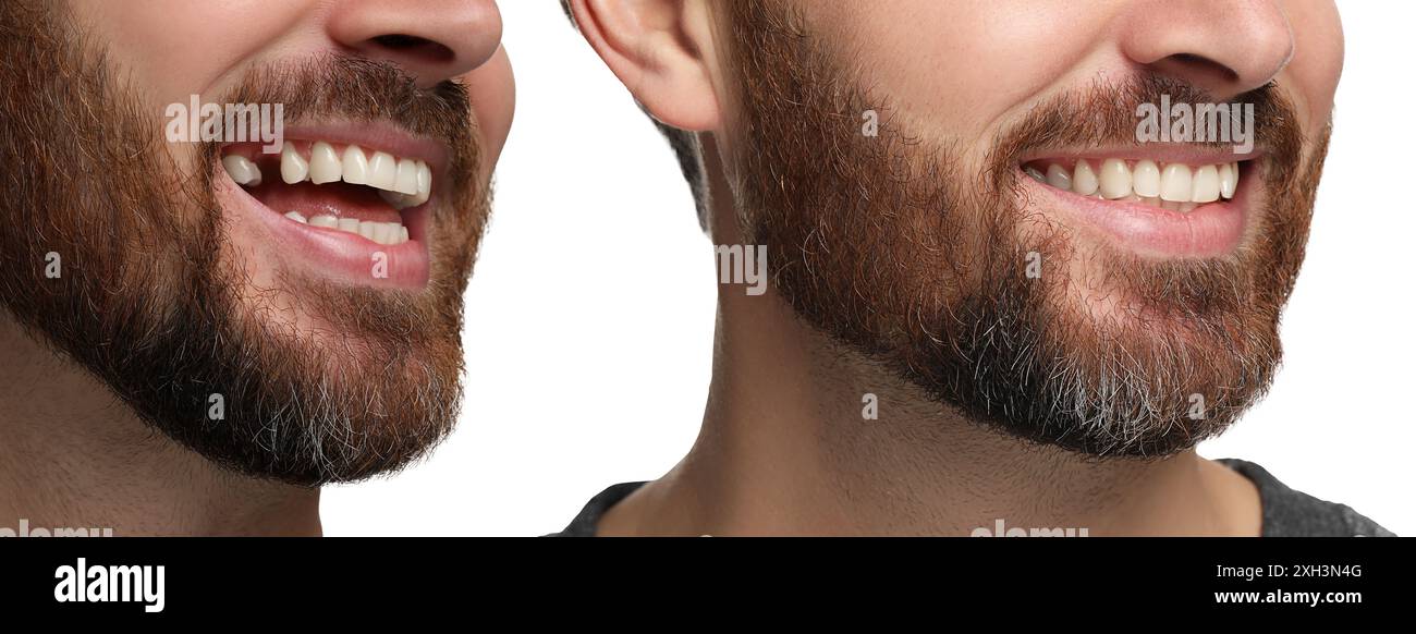 Man showing teeth before and after dental implant surgery, closeup ...