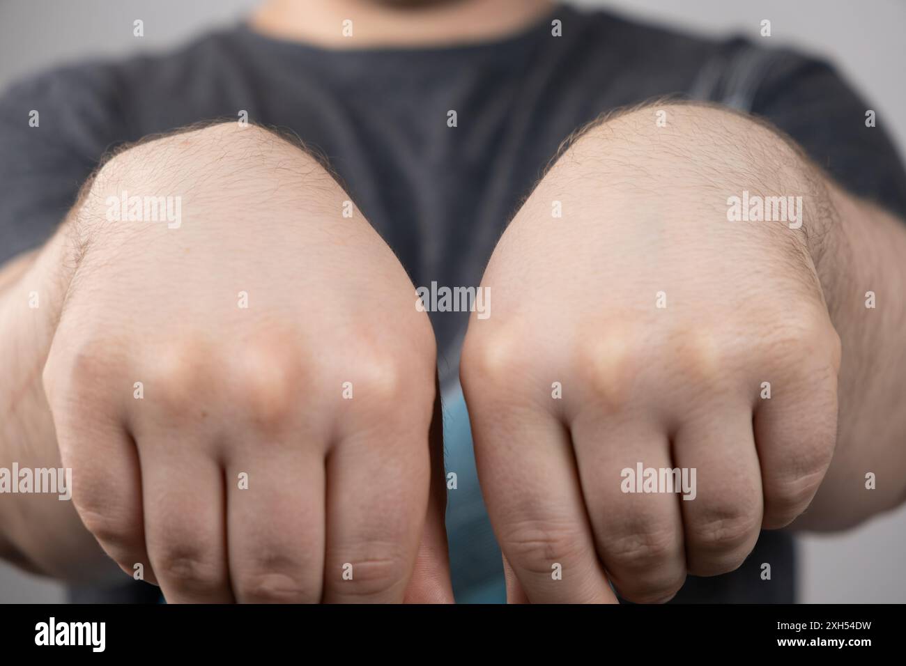 Comparison of healthy arm and arm with wrist ganglion cyst Stock Photo ...