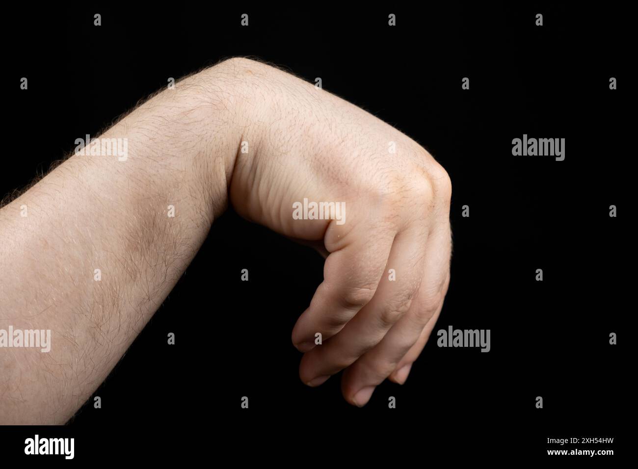 Ganglion cyst or hygroma of the wrist on the hand of a male patient ...