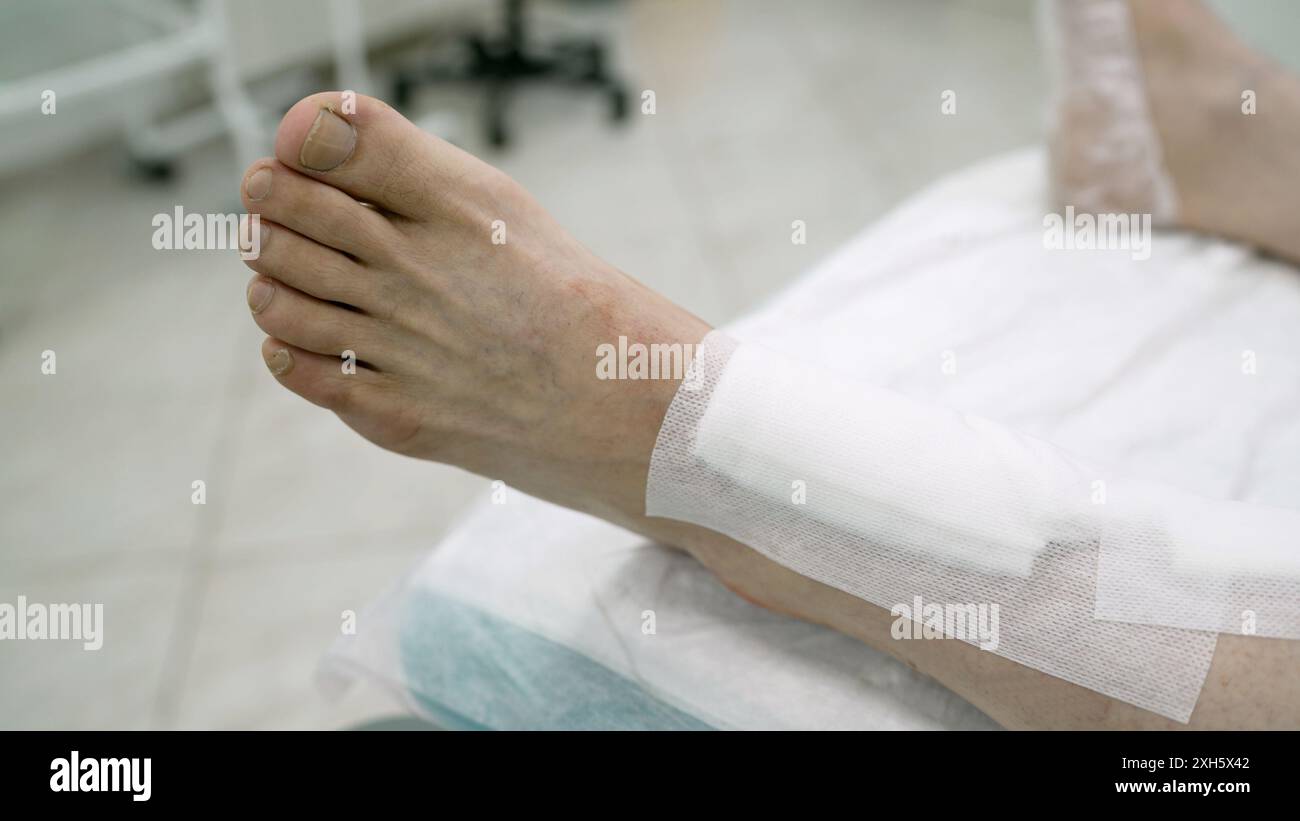 Operation on the veins of the legs. The doctor puts a bandage on the ...