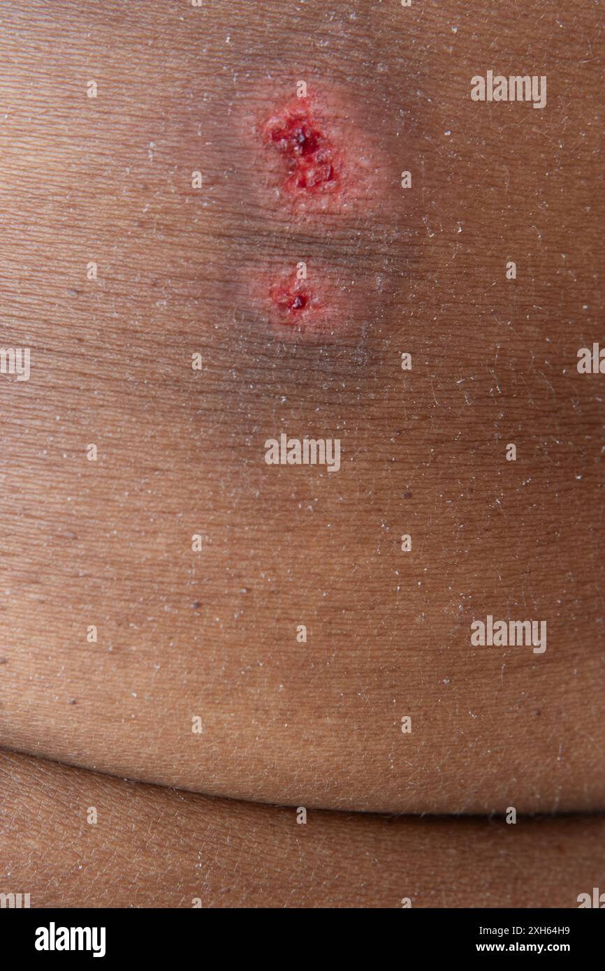 Close up of an infected wound healing on dark skin Stock Photo - Alamy