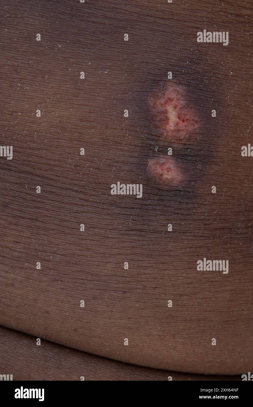 Back scars hi-res stock photography and images - Alamy