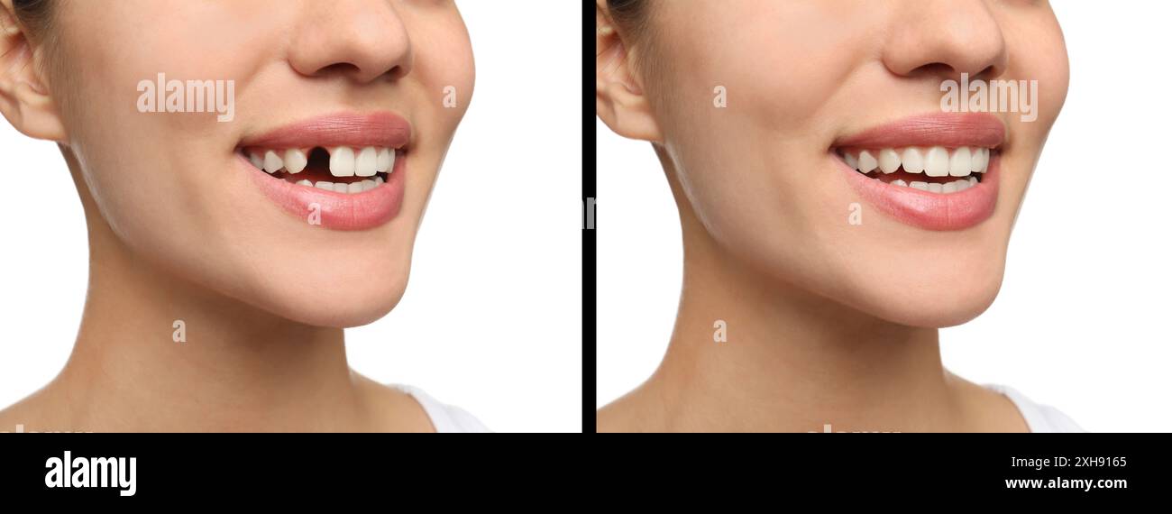 Woman showing teeth before and after dental implant surgery, closeup ...