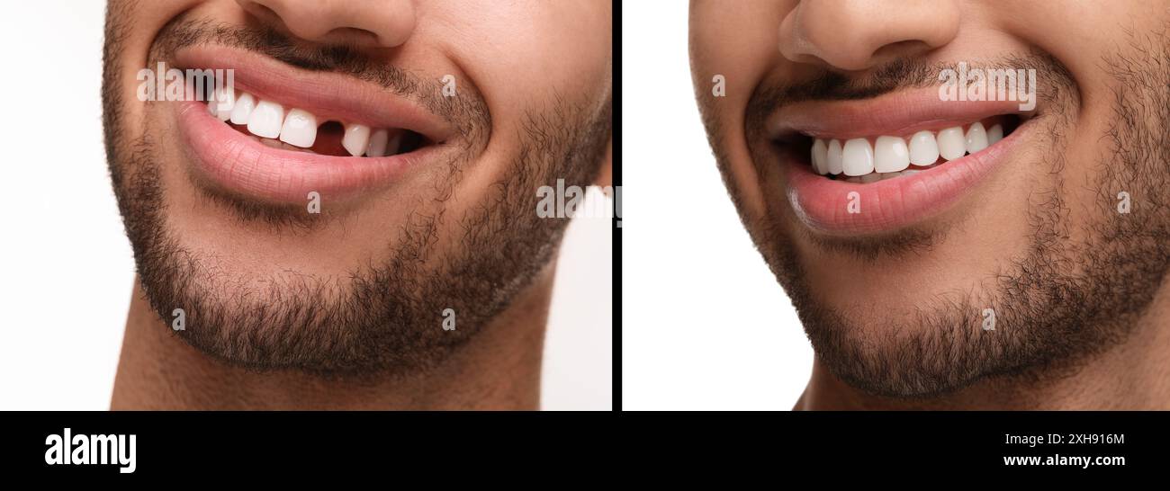 Man showing teeth before and after dental implant surgery, closeup ...