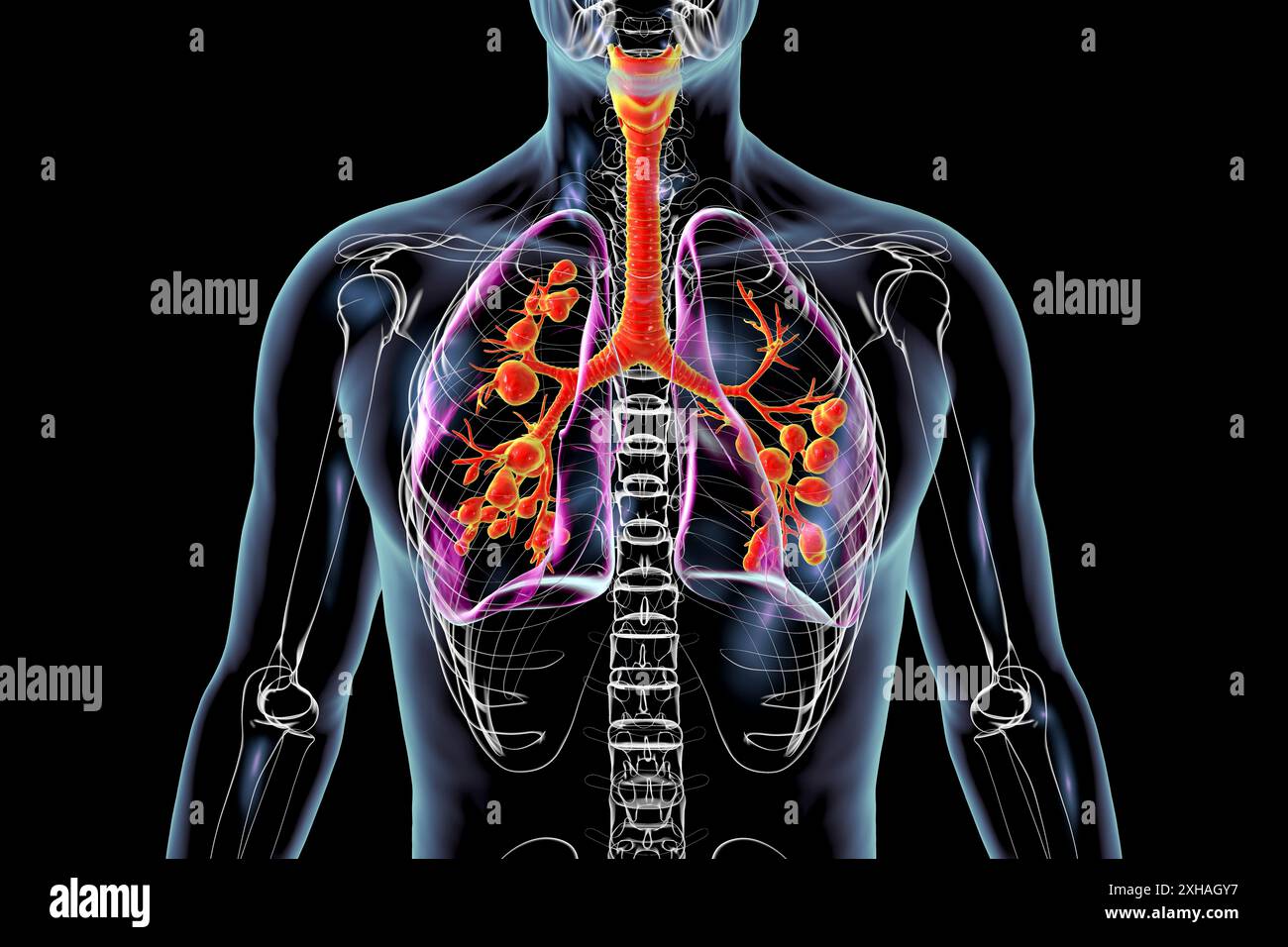 Illustration of lungs affected by cystic fibrosis, a genetic disorder ...