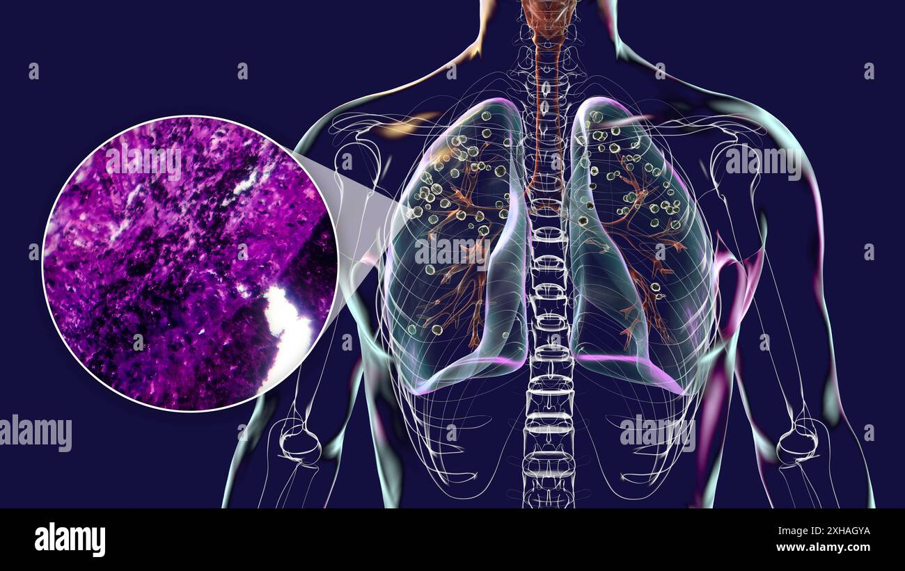 Illustration depicting lungs affected by silicosis, revealing dark ...