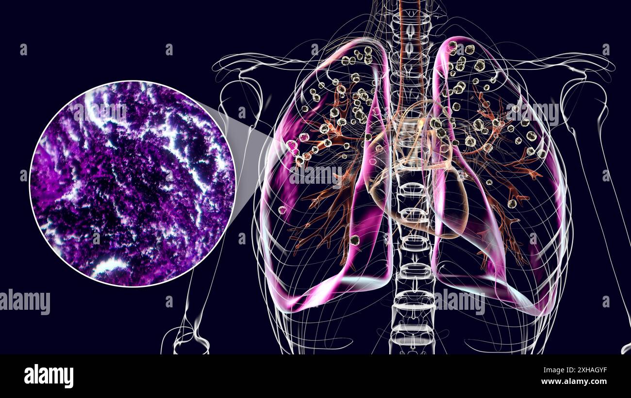 Illustration depicting lungs affected by silicosis, revealing dark ...