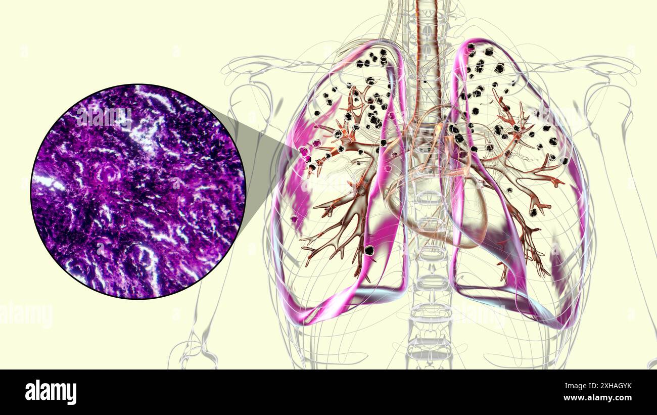 Illustration depicting lungs affected by silicosis, revealing dark silicotic nodules, along with ...
