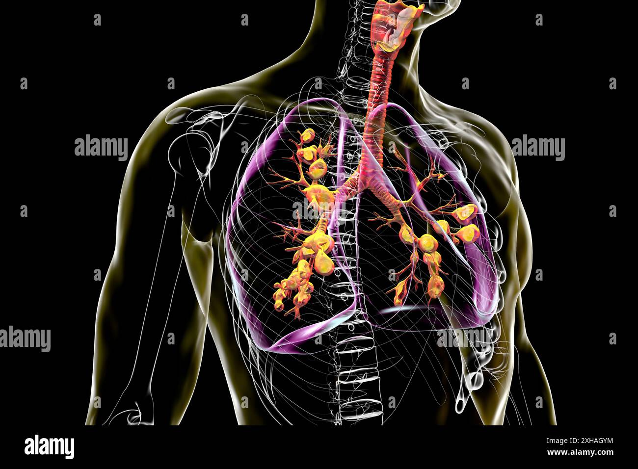 Illustration of lungs affected by cystic fibrosis, a genetic disorder ...