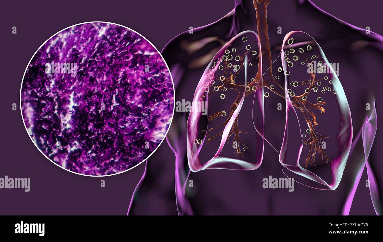 Illustration depicting lungs affected by silicosis, revealing dark silicotic nodules, along with ...