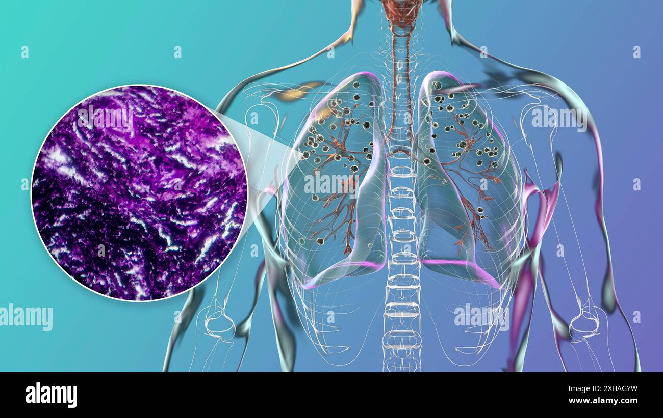 Illustration depicting lungs affected by silicosis, revealing dark silicotic nodules, along with ...
