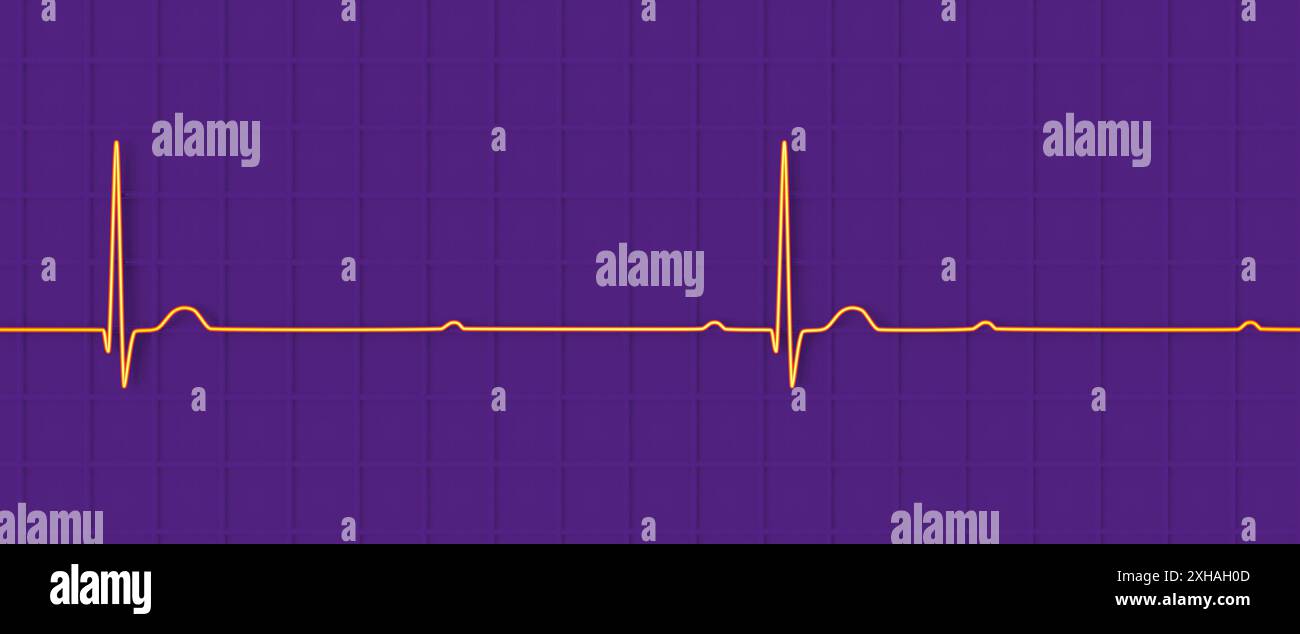 Illustration of an electrocardiogram (ECG) depicting a complete heart ...
