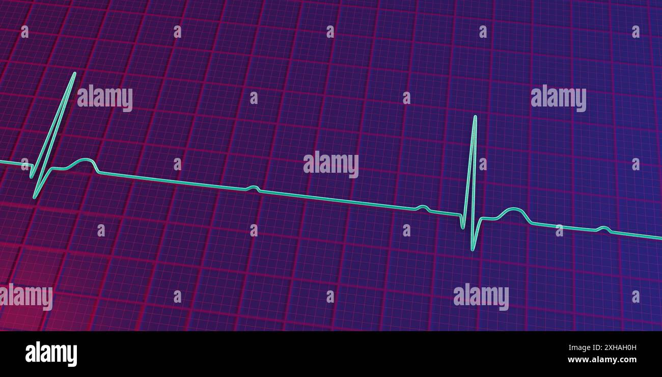 Illustration Of An Electrocardiogram Ecg Depicting A Complete Heart Block 3rd