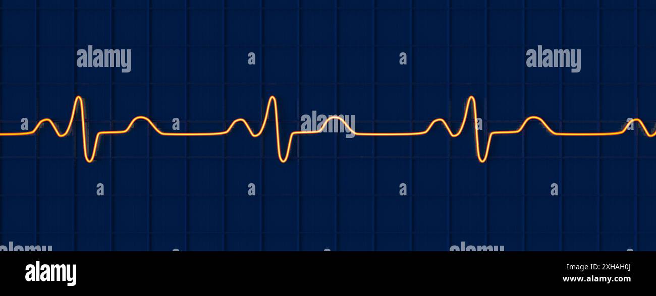 Illustration of an electrocardiogram (ECG) depicting a bundle branch ...