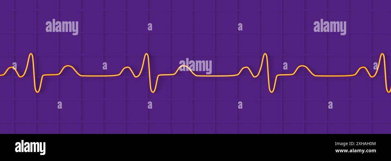 Illustration of an electrocardiogram (ECG) depicting a bundle branch ...