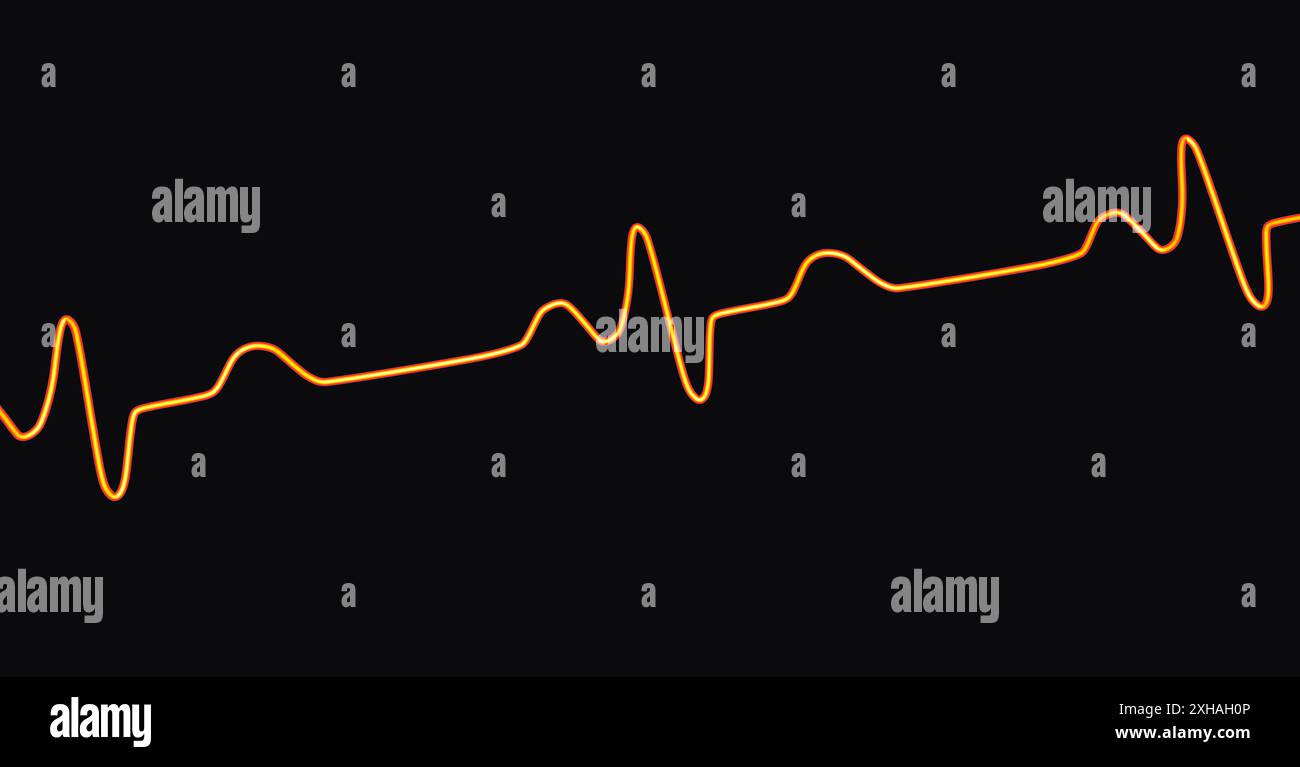 Illustration of an electrocardiogram (ECG) depicting a bundle branch ...