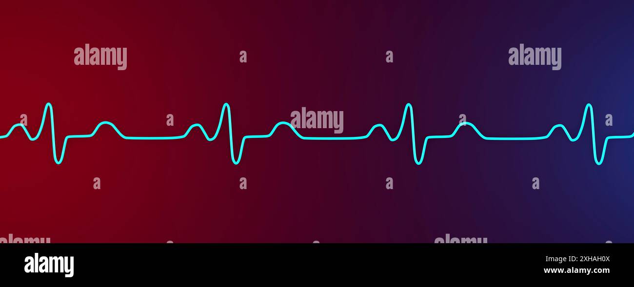 Illustration of an electrocardiogram (ECG) depicting a bundle branch ...