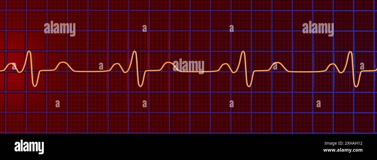 Illustration of an electrocardiogram (ECG) depicting a bundle branch ...