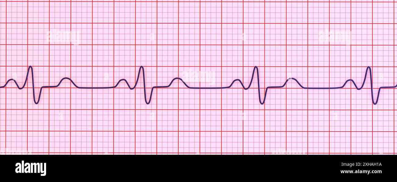 Illustration of an electrocardiogram (ECG) depicting a bundle branch ...