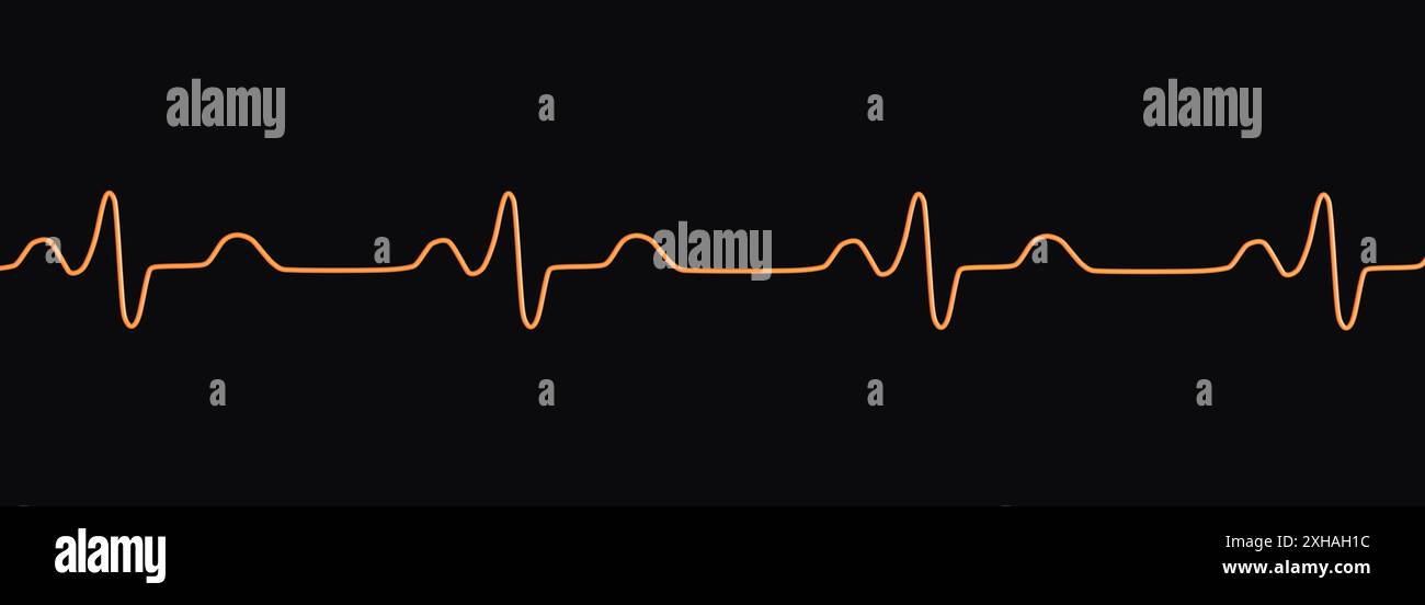 Illustration of an electrocardiogram (ECG) depicting a bundle branch ...