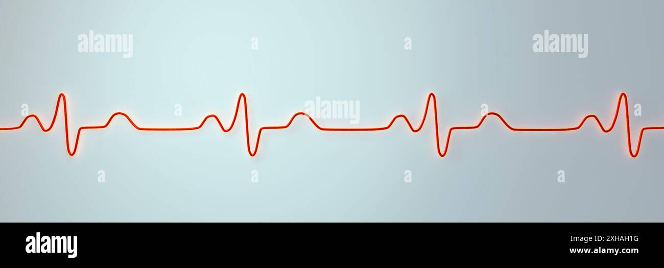 Illustration of an electrocardiogram (ECG) depicting a bundle branch ...