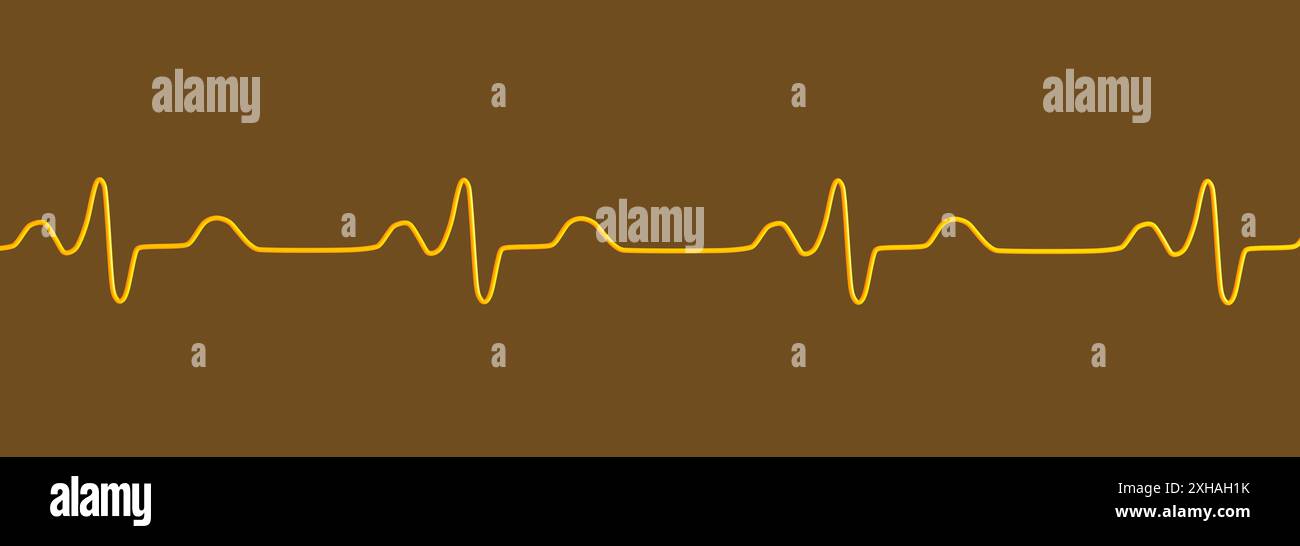 Illustration of an electrocardiogram (ECG) depicting a bundle branch ...