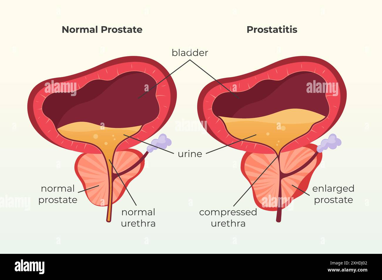 Normal Prostate Gland under Bladder vs Prostatitis - Stock Illustration as EPS 10 File Stock ...