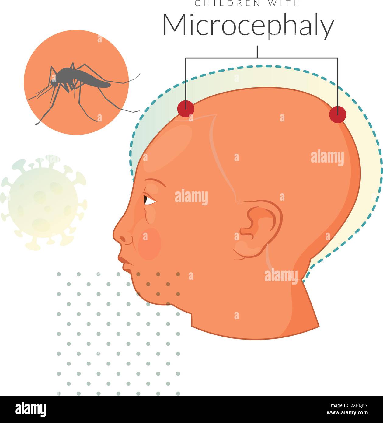 Children with microcephaly - Zika Virus - Stock Illustration as EPS 10 ...