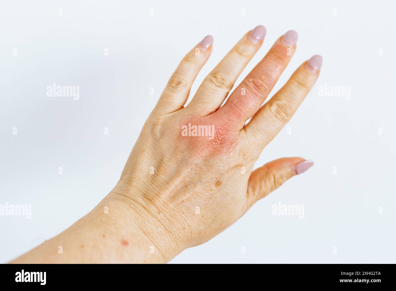 hand swollen from wasp sting Stock Photo - Alamy