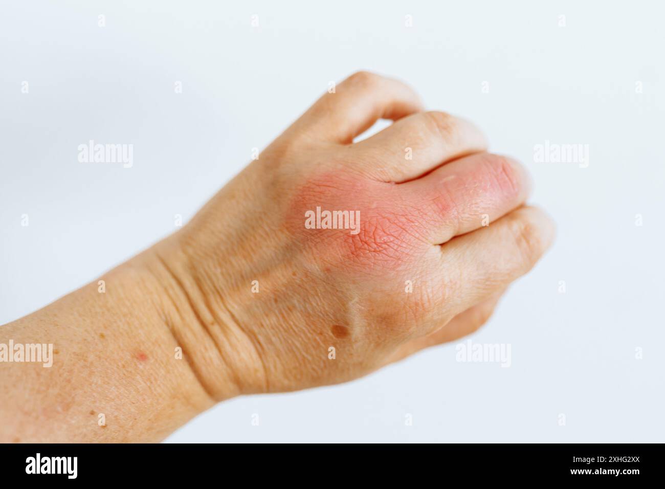 hand swollen from wasp sting Stock Photo - Alamy
