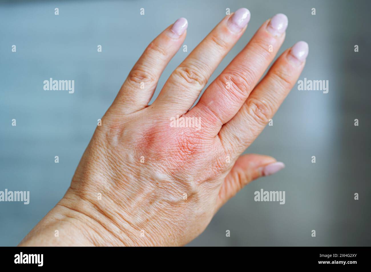 hand swollen from wasp sting Stock Photo - Alamy