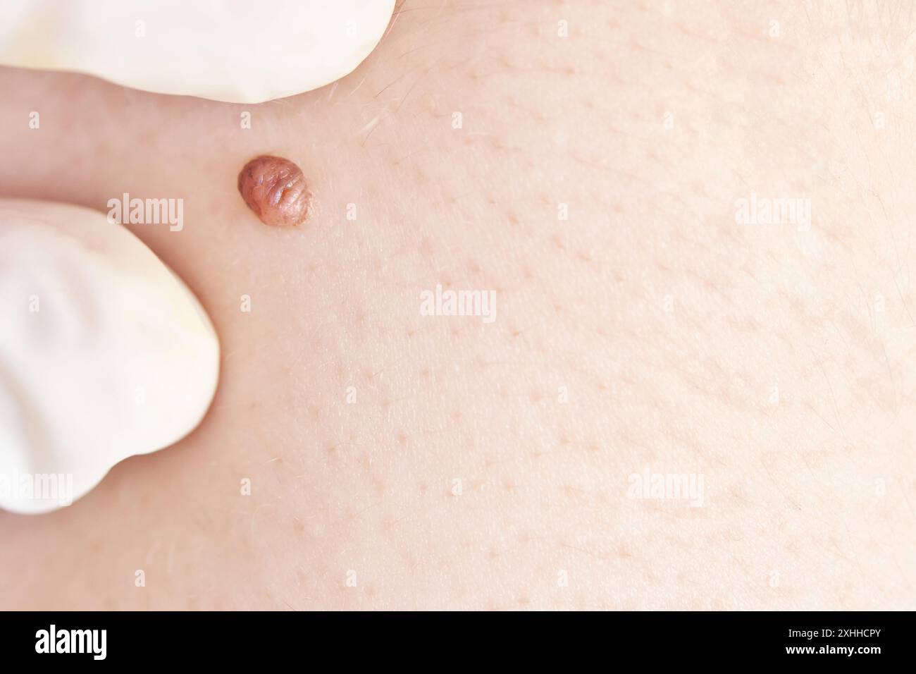 Woman examing her abnormal mole. Dermatology procedure. Doctor checking ...