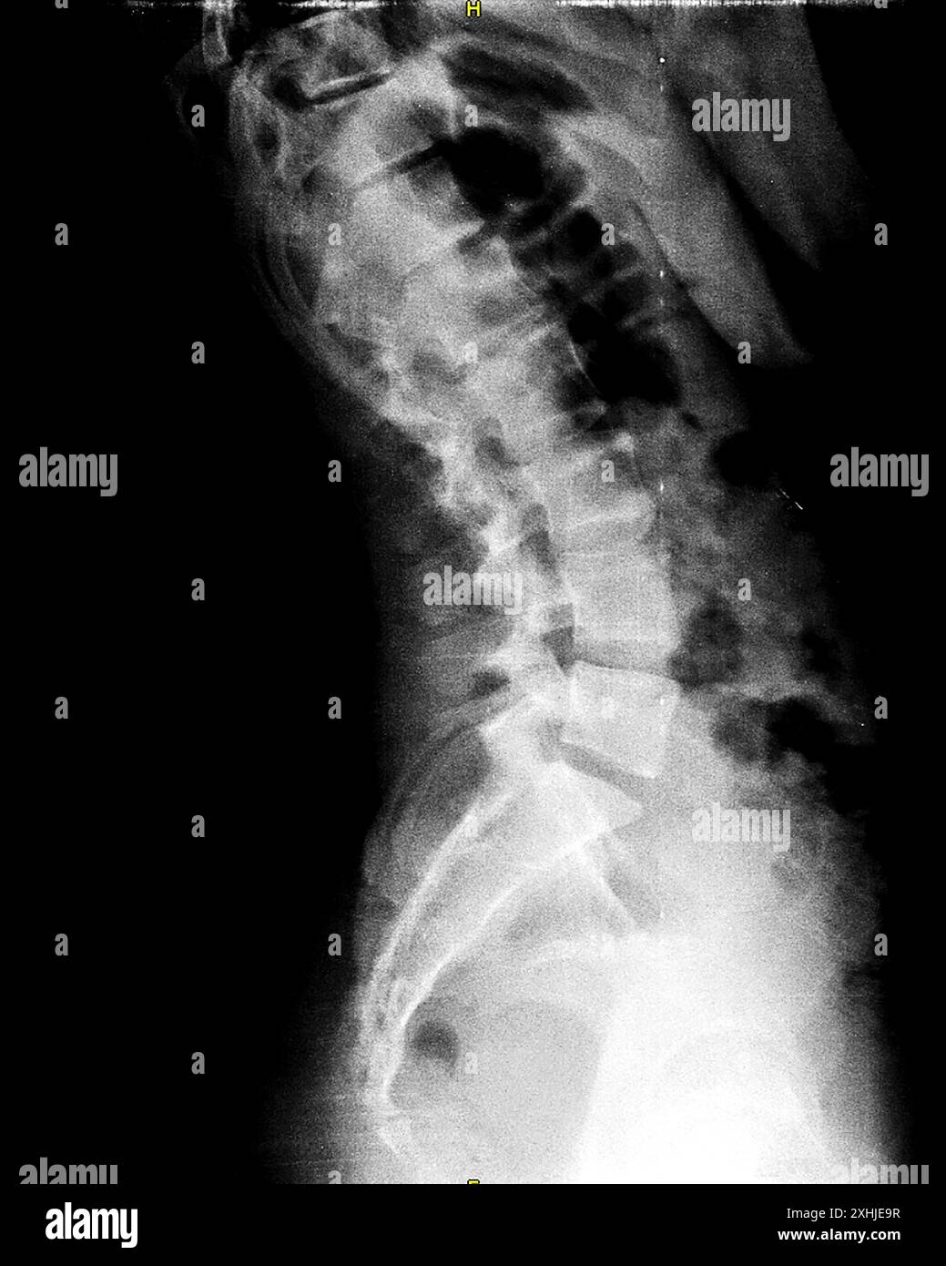 Spine lateral view hi-res stock photography and images - Alamy