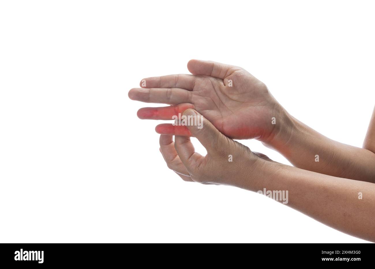 Numbness and tingling is a symptom of Ulnar tunnel syndrome, also known ...