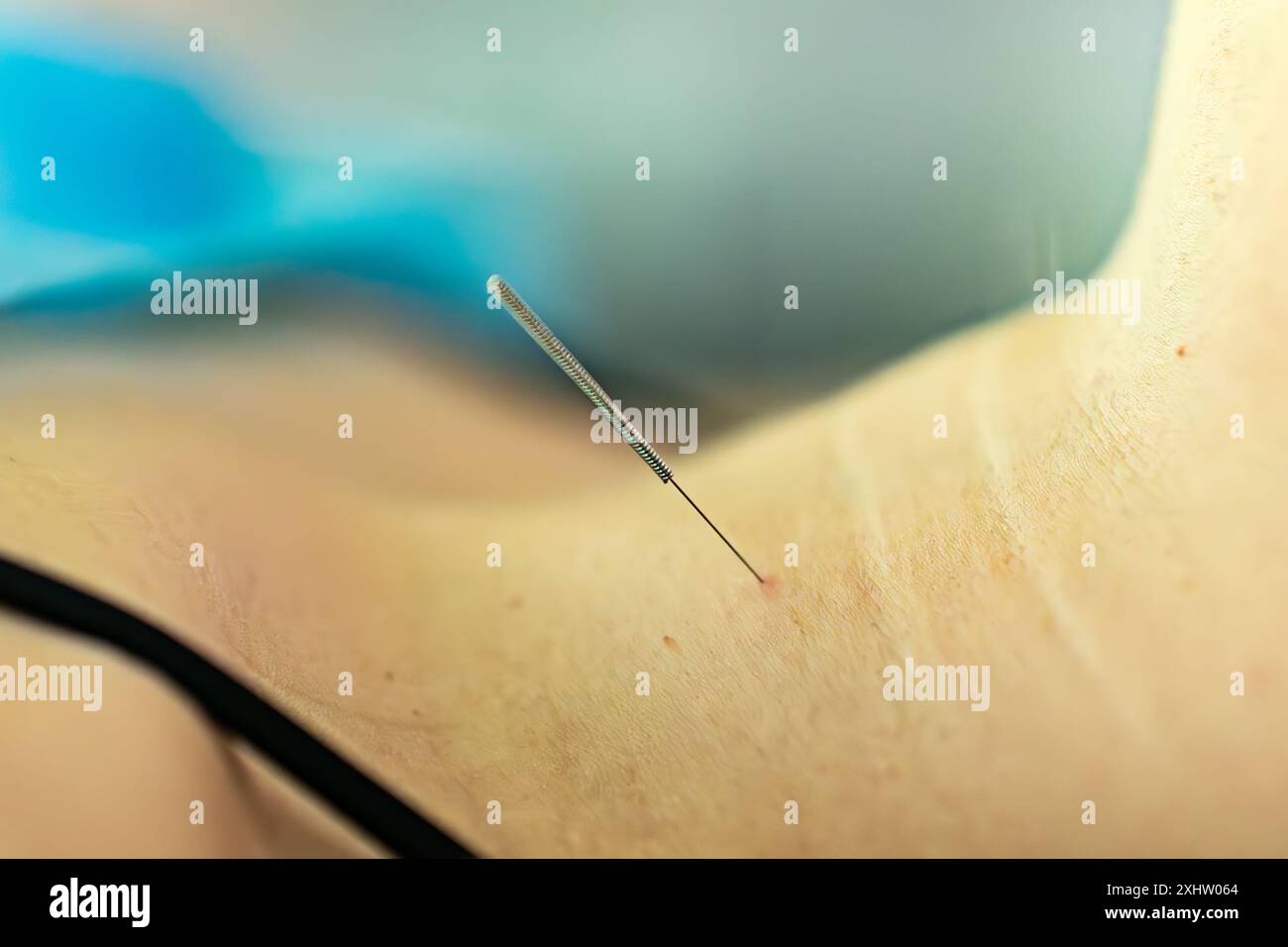 Dry Needle Acupuncture Treatment. Female Medical Spa Therapy Stock ...