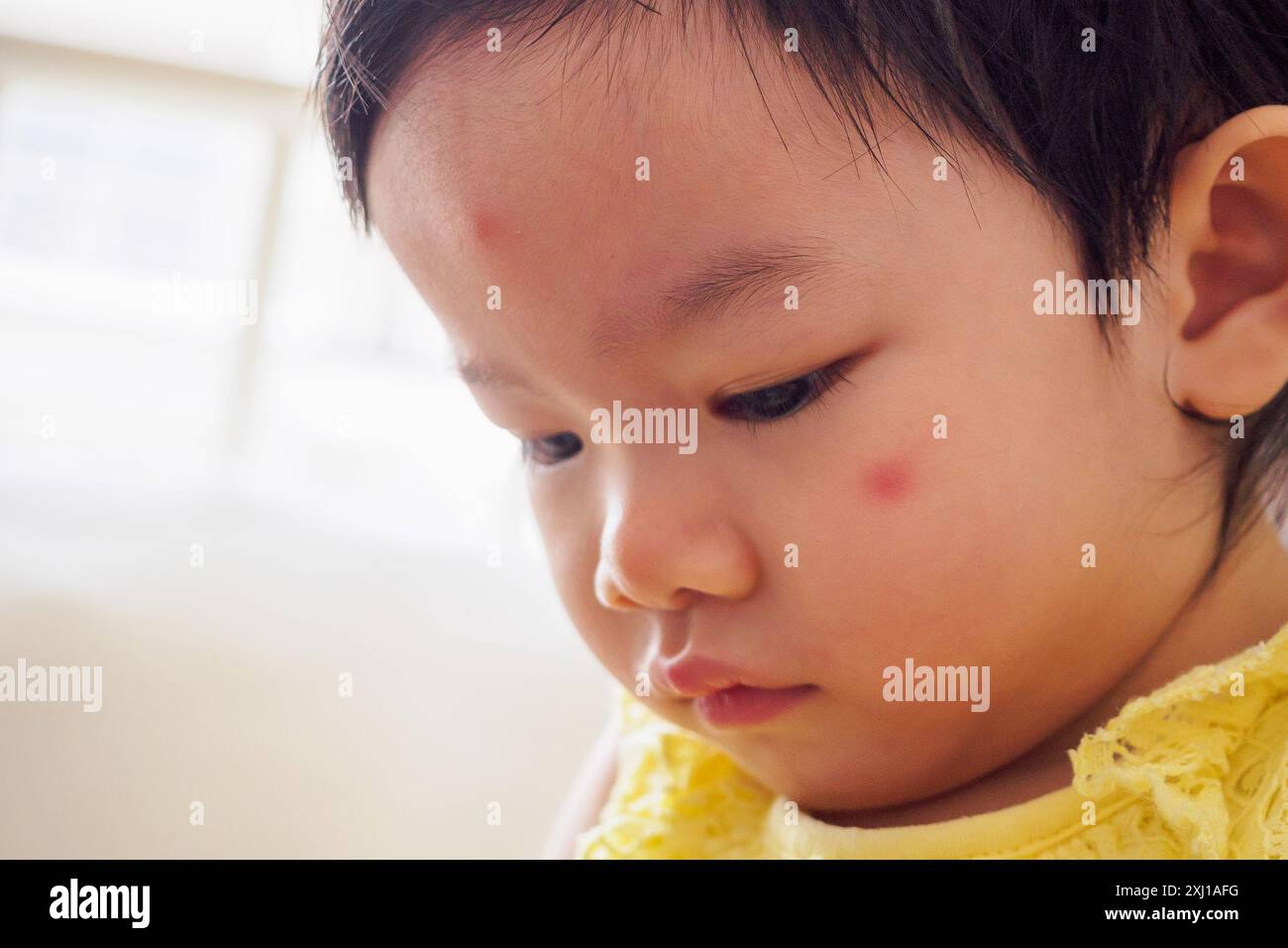 Mosquito bite face hi-res stock photography and images - Alamy