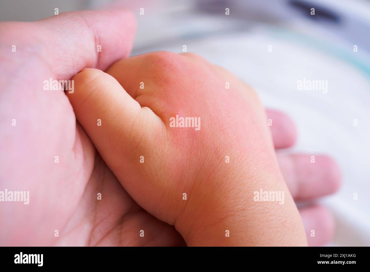 baby hand with skin rash and allergy with red spot cause by mosquito ...