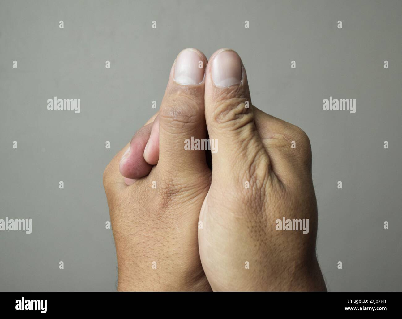 The wound was cut on the thumb. Wounds are caused by knive Stock Photo ...