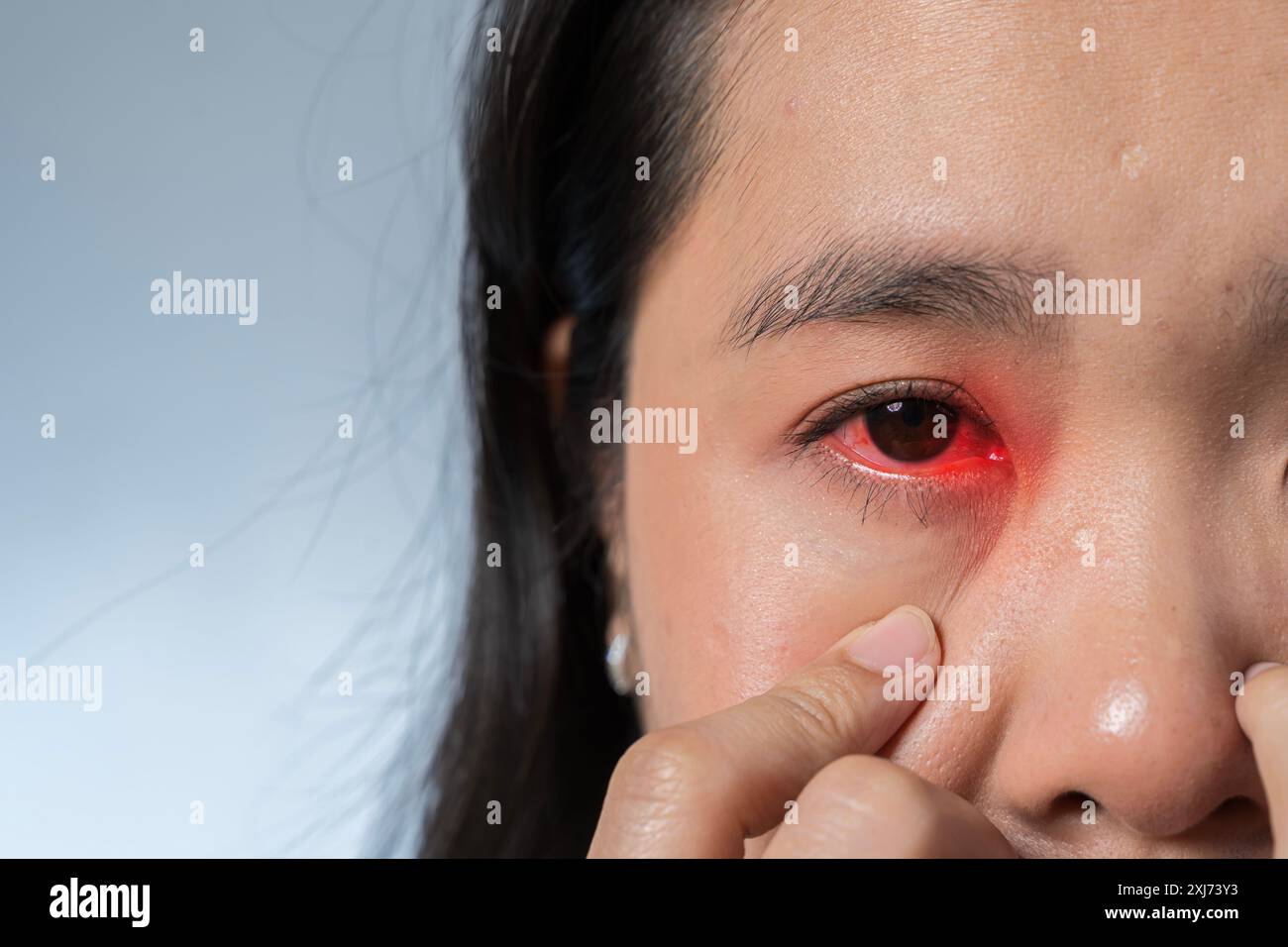 Close up portrait of women with red eye before and after treatment or ...